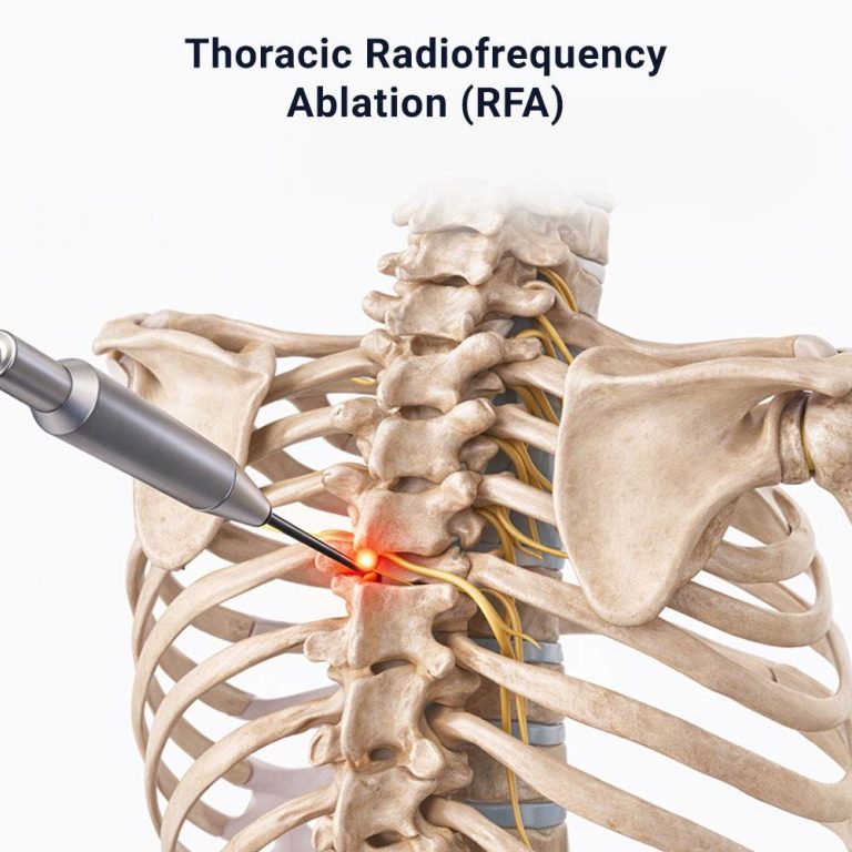 Thoracic Radiofrequency Ablation (RFA) in NJ & NYC